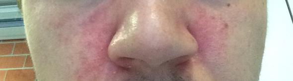 Rötungen um die Nase seit Jahren, was tun? (Krankheit, Aussehen, Gesicht)