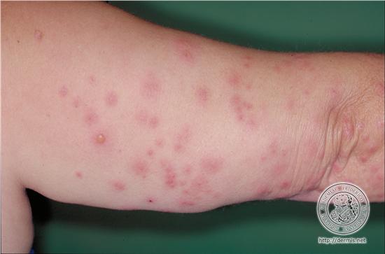 Wanzenstiche erkennen, wie? (Gesundheit, Stich, Wanzen)