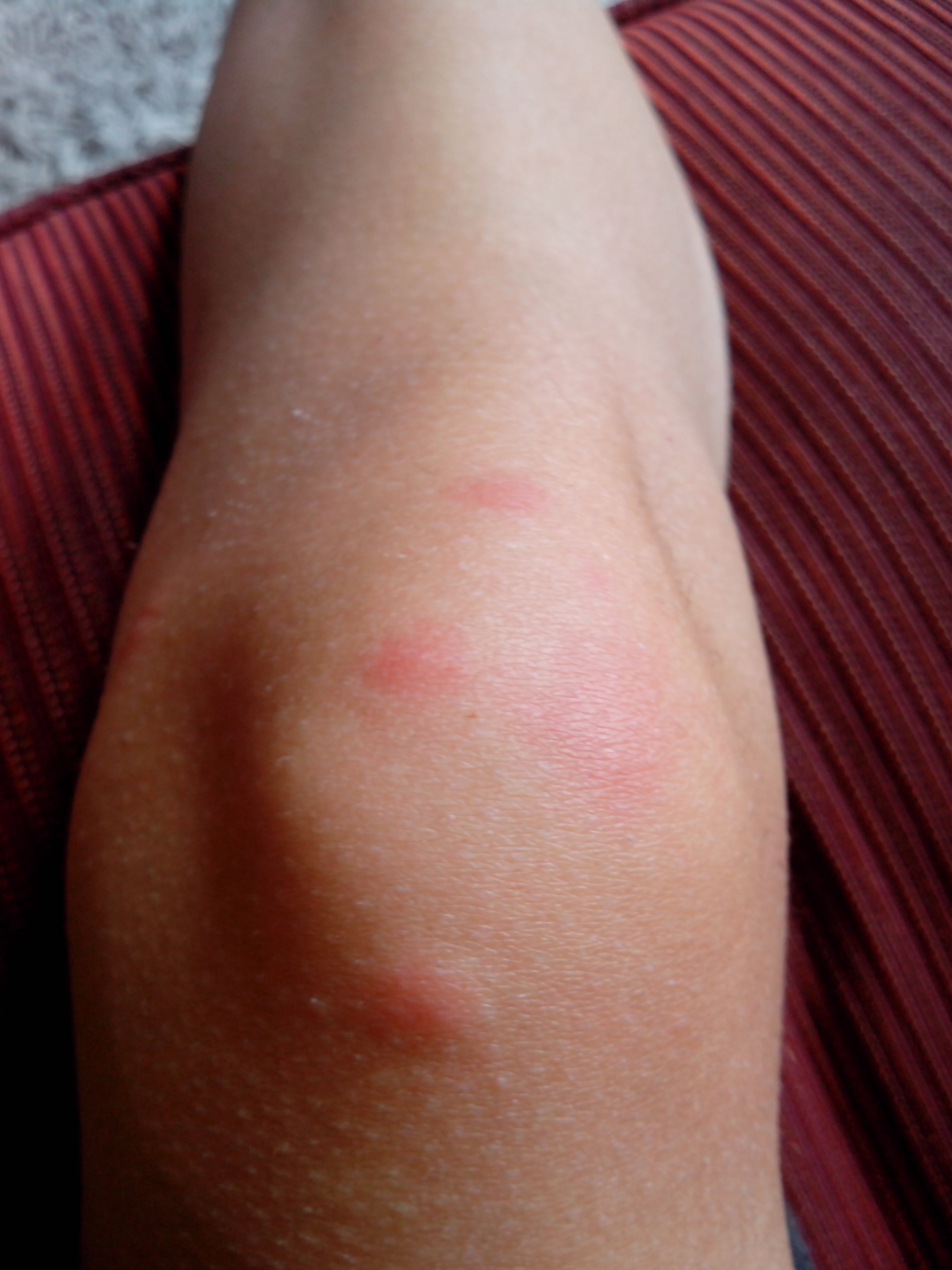 Rote Flecken/Bisse am Knie. Wanzen -, Floh -, oder Grasmilbenbiss ...