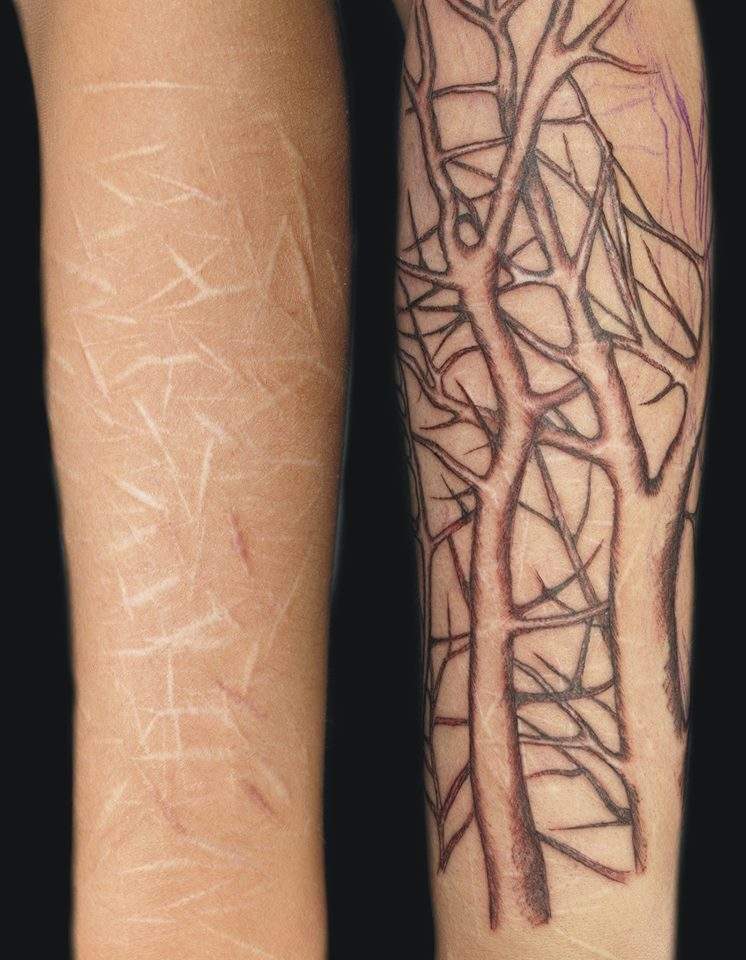 Narben vom SSV übertättowieren? (Tattoo)