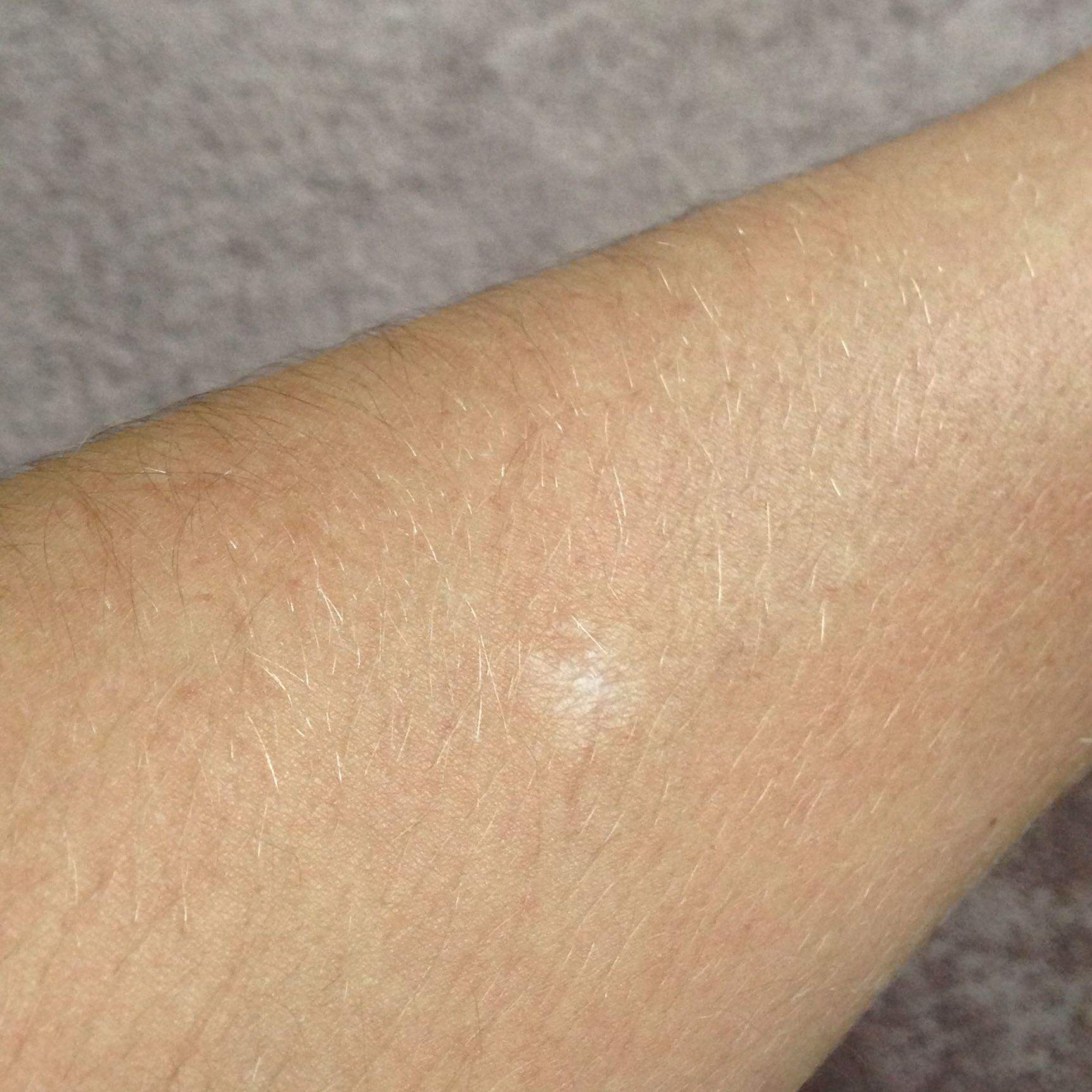 Wie soll ich meine Brandwunde behandeln? (Zigaretten, Wunde)