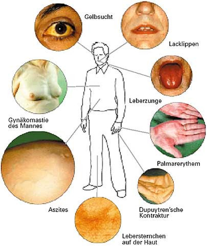 Woran erkenne ich ob ich einen Leberschaden habe? (Arzt, Symptome)