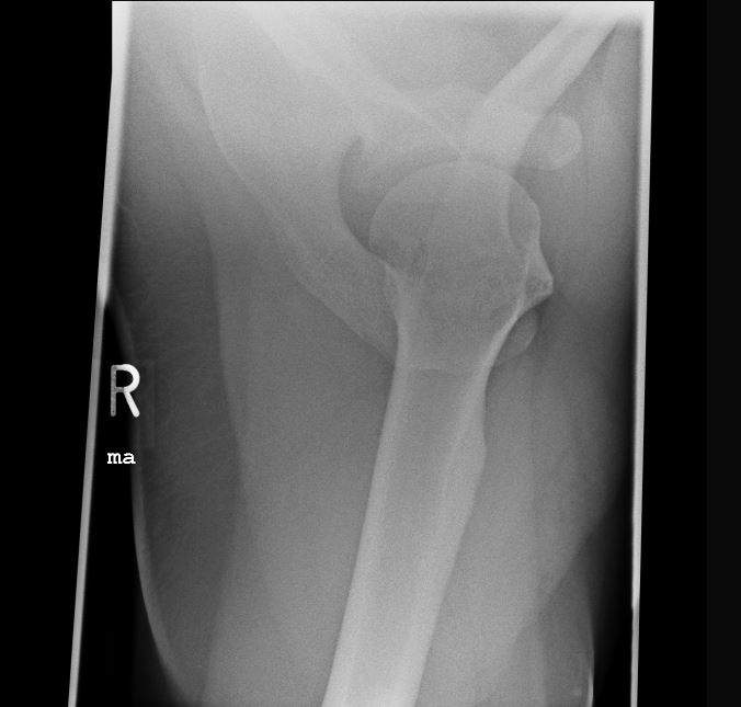 Zyste in Schulter, Arzt gibt keine Infos? (Gesundheit, Medizin, Schmerzen)