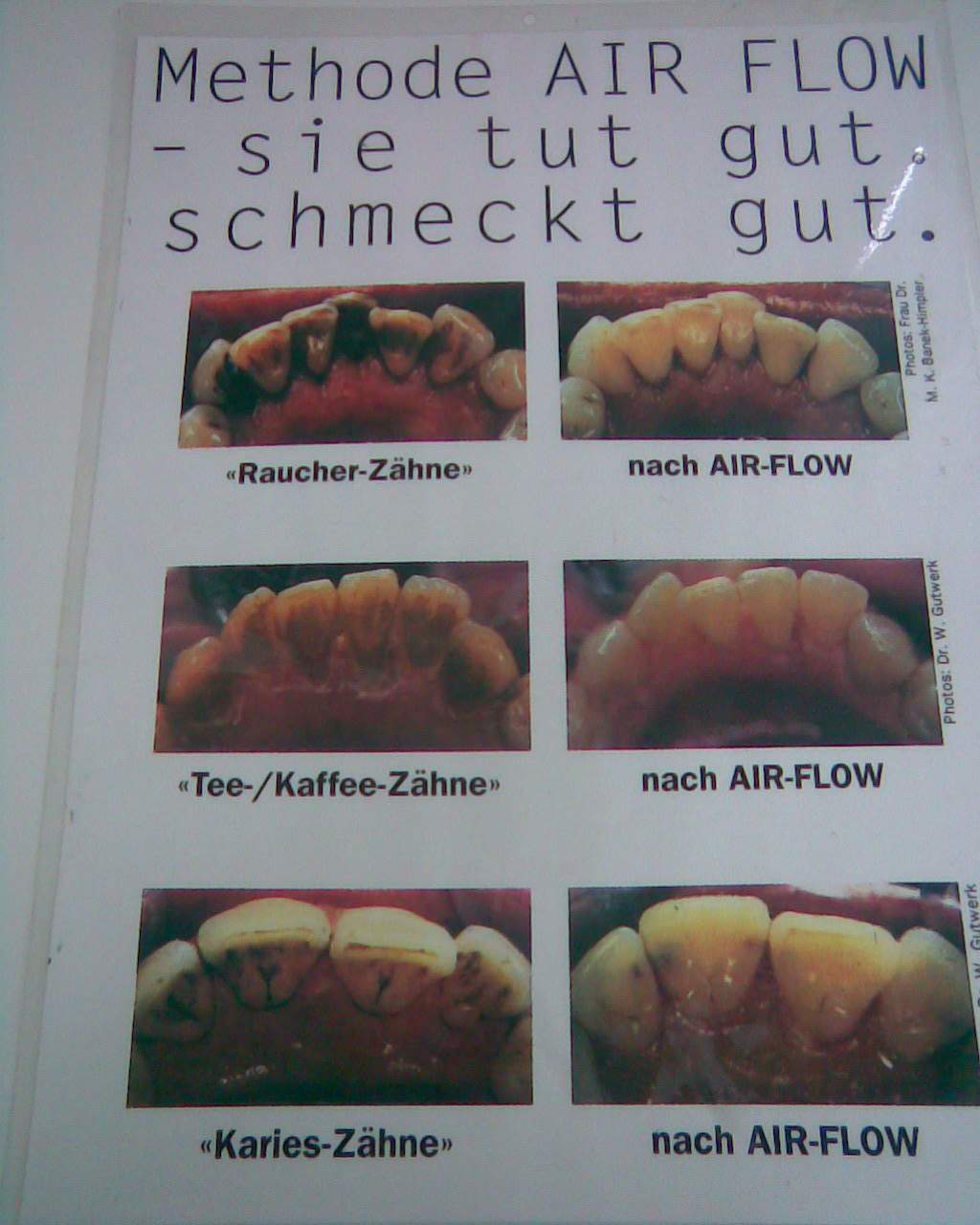 Was ist das graue an den Zähnen und wie bekommt man das wieder weg ...