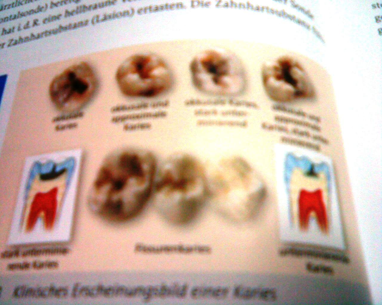 Ist da Karies oder eine Verfärbung? (Zähne, Zahnarzt, Kariesbehandlung)