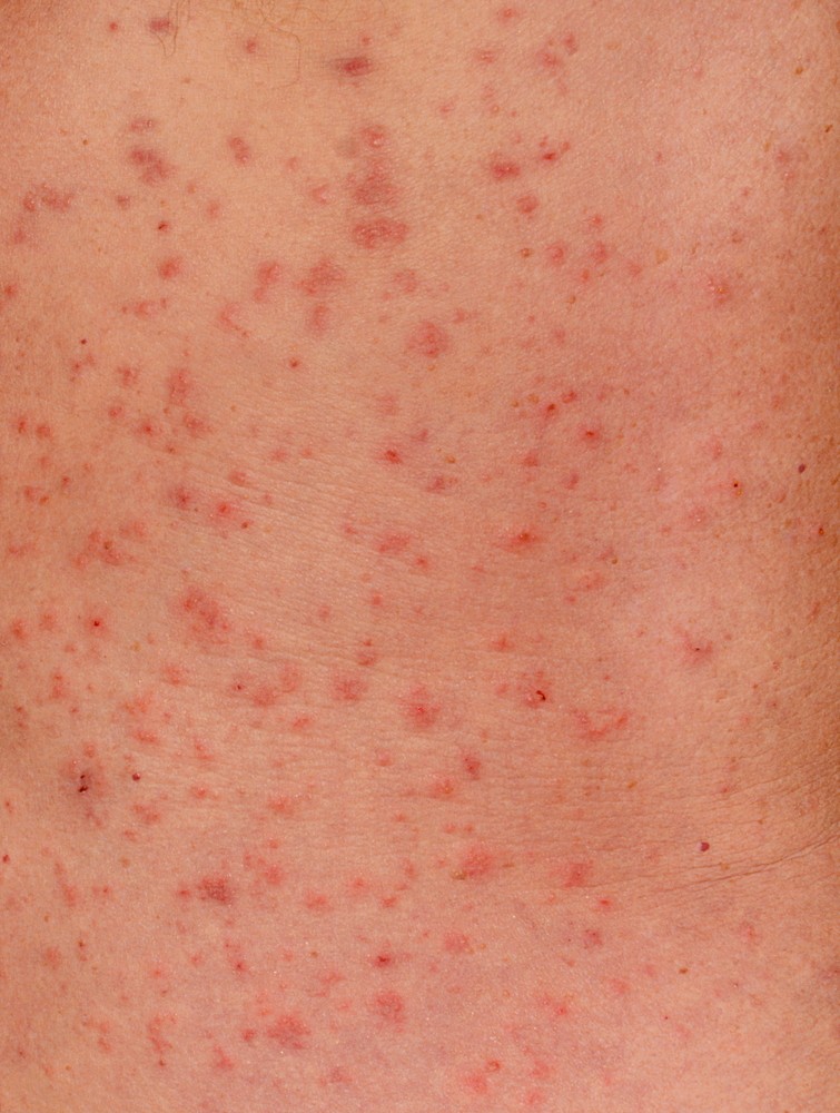 Krätze Erfahrungen? (Gesundheit und Medizin, Haut)