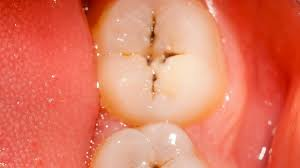 Ist das Karies? Und wenn ja wie weit fortgeschritten? (Zähne ...