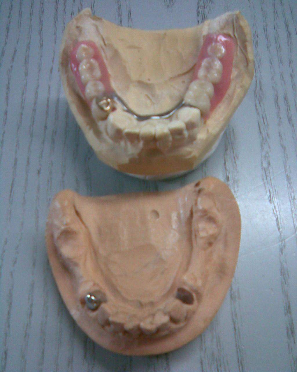 Ist eine Deckprothese eine gute Alternative zur Modellgussprothese ...