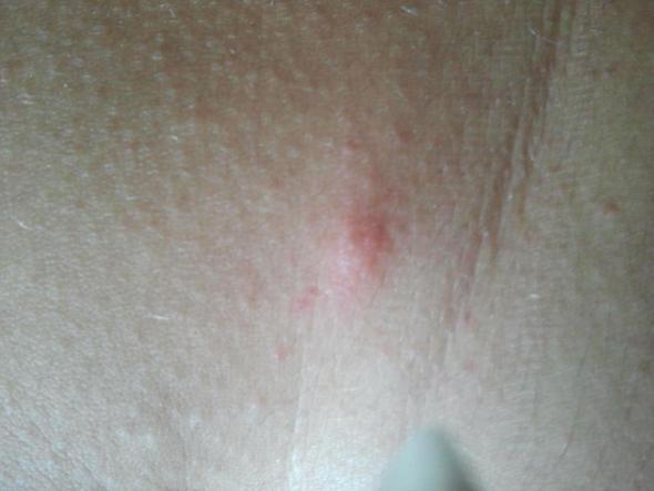 Wasserbläschen am ganzen Körper (Ausschlag)