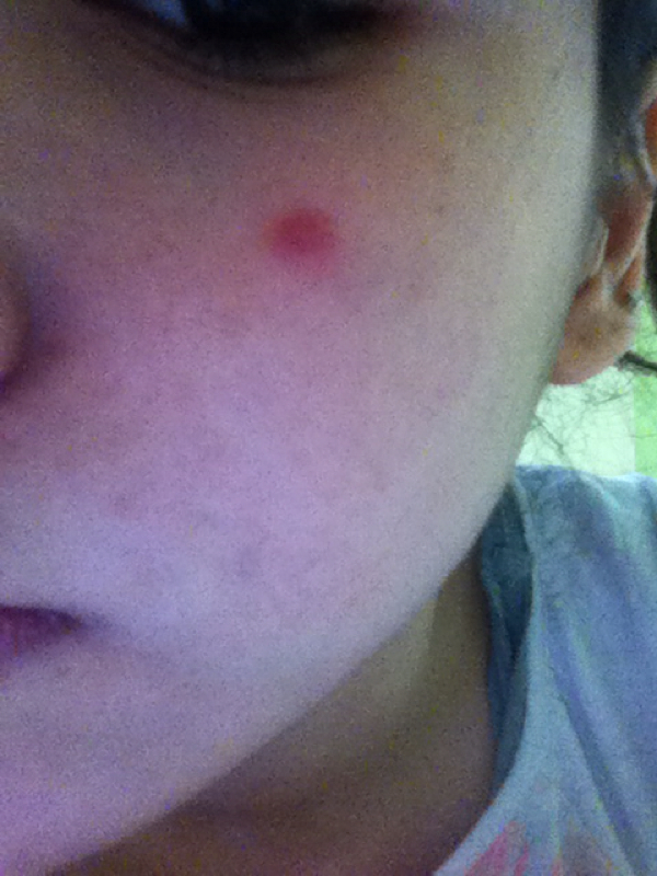 Hilfe wie bekomm ich rote flecken weg -von Pickeln