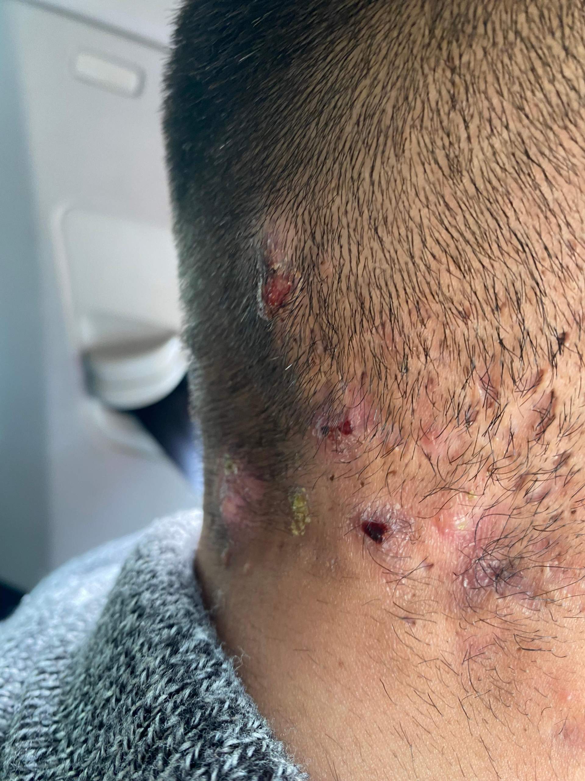 Akne und Furunkel..? (Gesundheit und Medizin, Körper, Pickel)