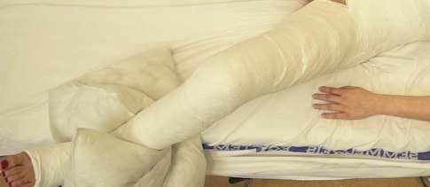 Amputierte Bein gebrochen , war das unsere Strafe? (Gips, krücken ...