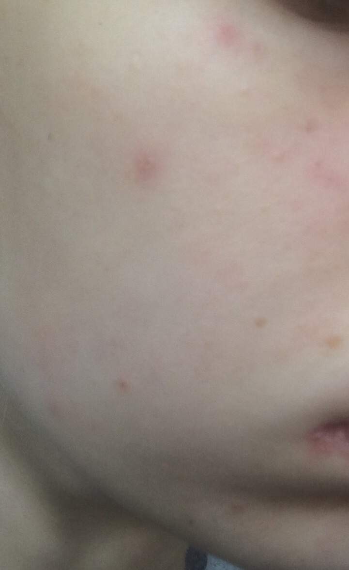 Anfang von Akne oder was anderes? (Beauty, Haut)