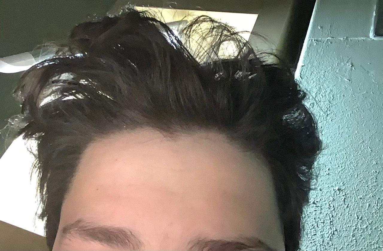 Angeborener Haaransatz oder Haarausfall mit 15? (Gesundheit und Medizin ...