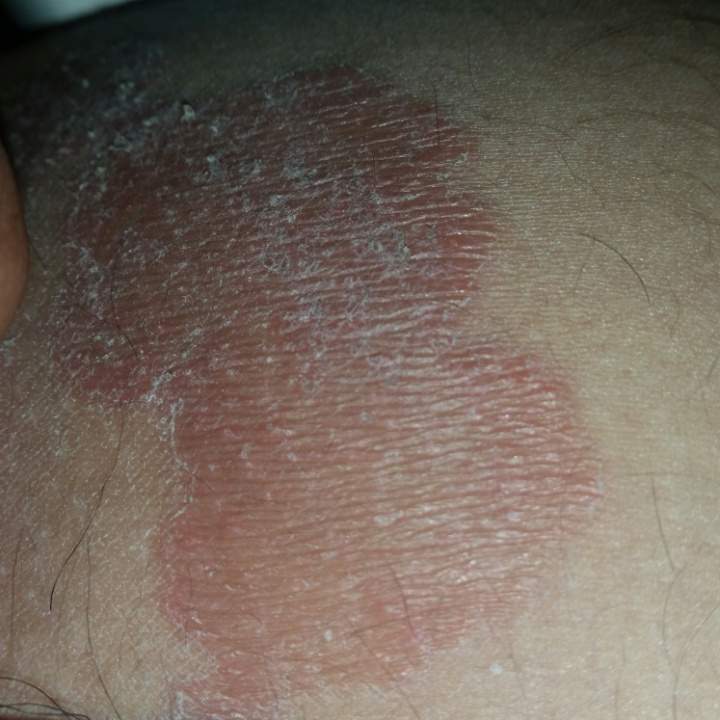 Ausschlag im Intimbereich, weiß jemand was das ist?