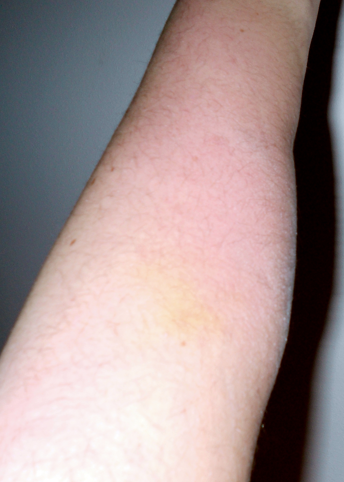 Ausbeulung Am Arm Schmerzen Wunde ausbeulung-am-arm-schmerzen-wunde