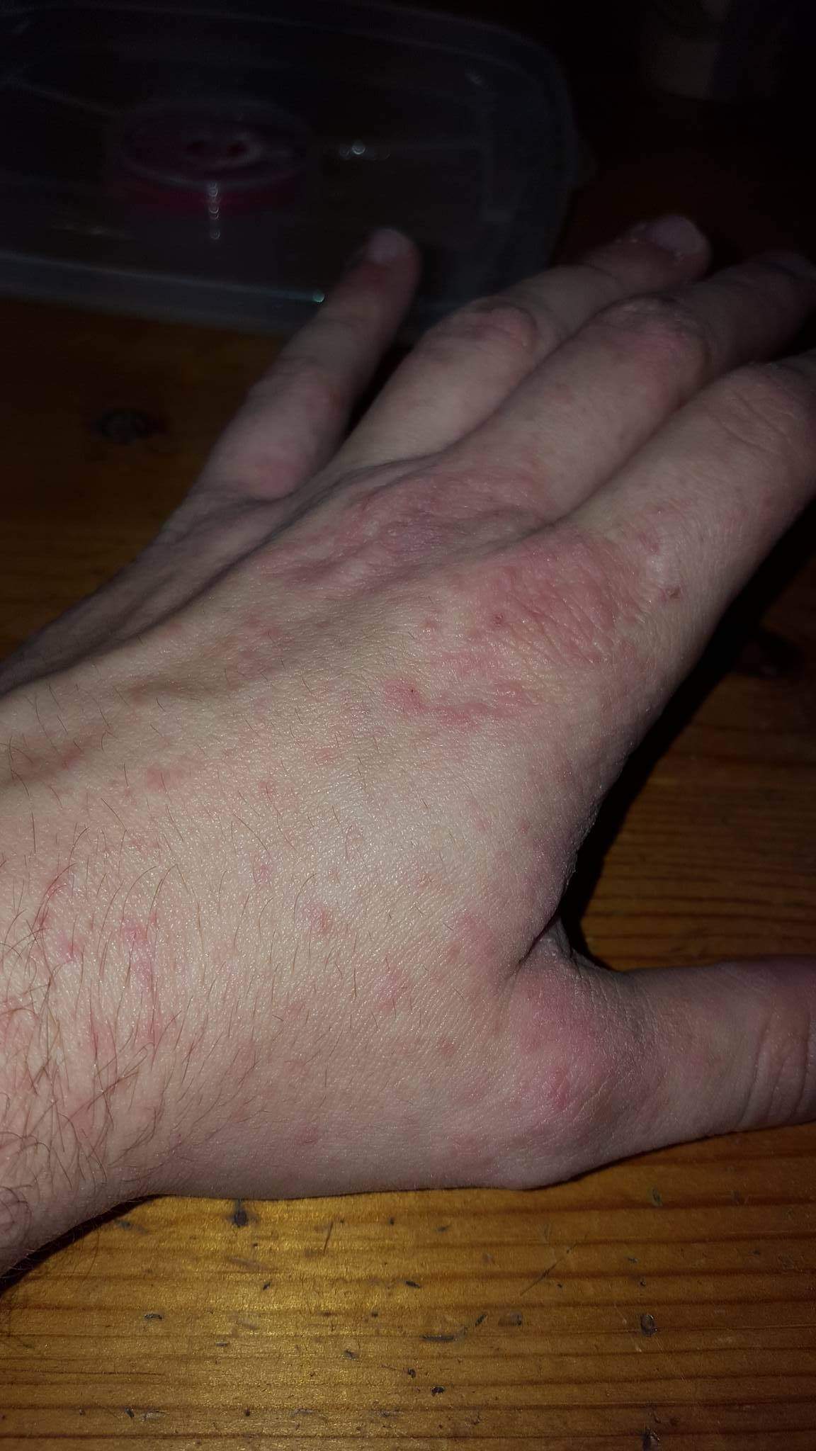 Ausschlag an linker Hand und Juckreiz am ganzen Körper? (rote-punkte ...