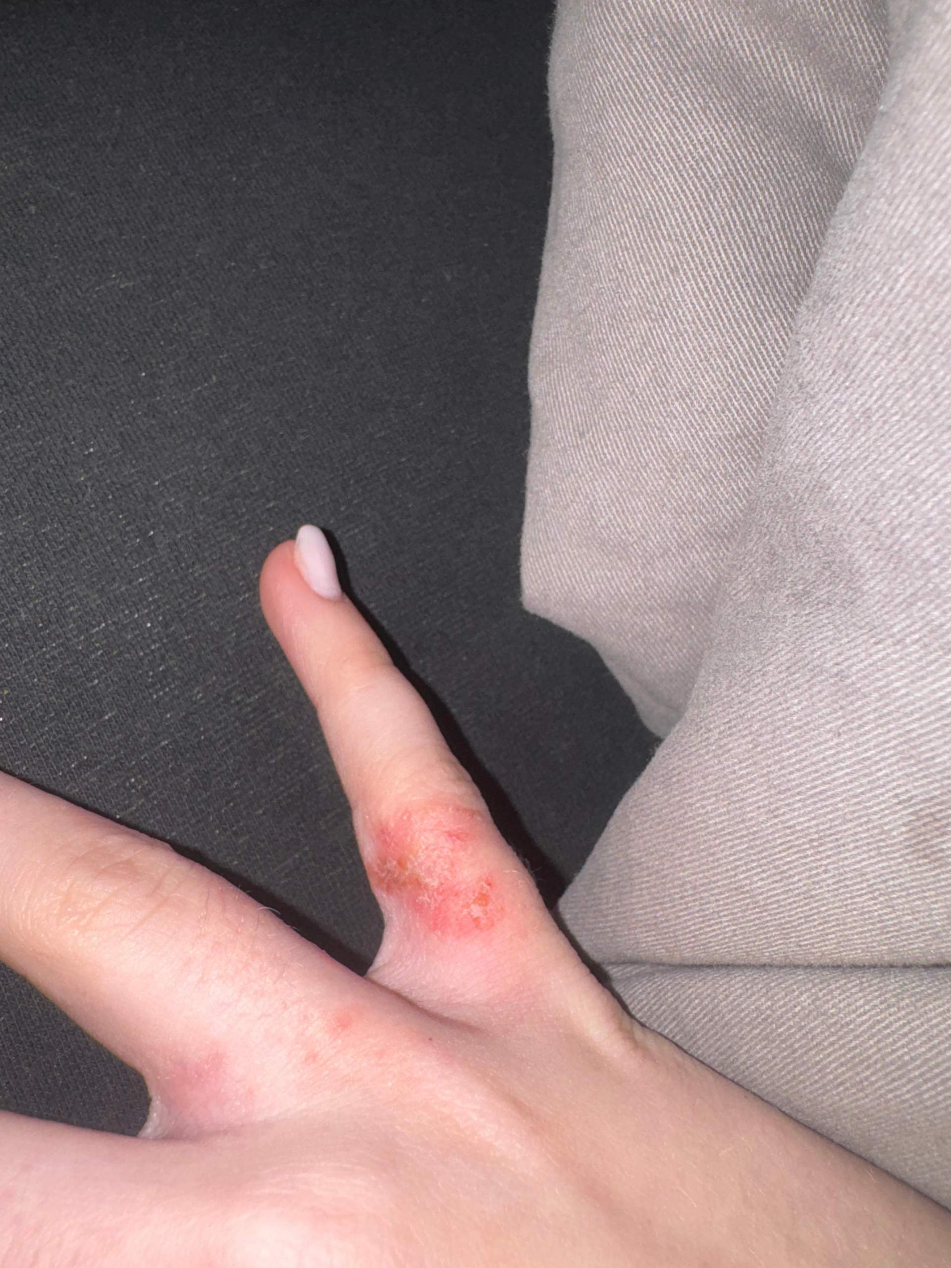 Ausschlag An Finger