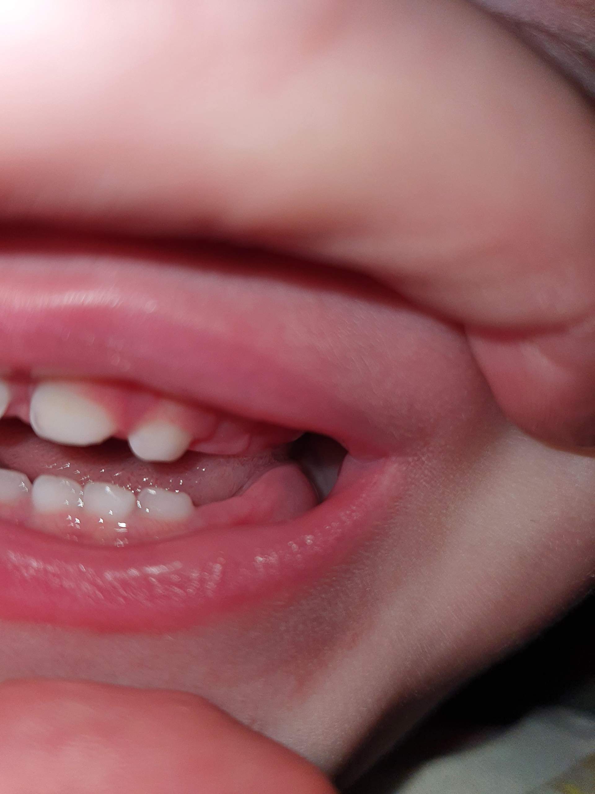 Baby backenzahn? (Zähne)