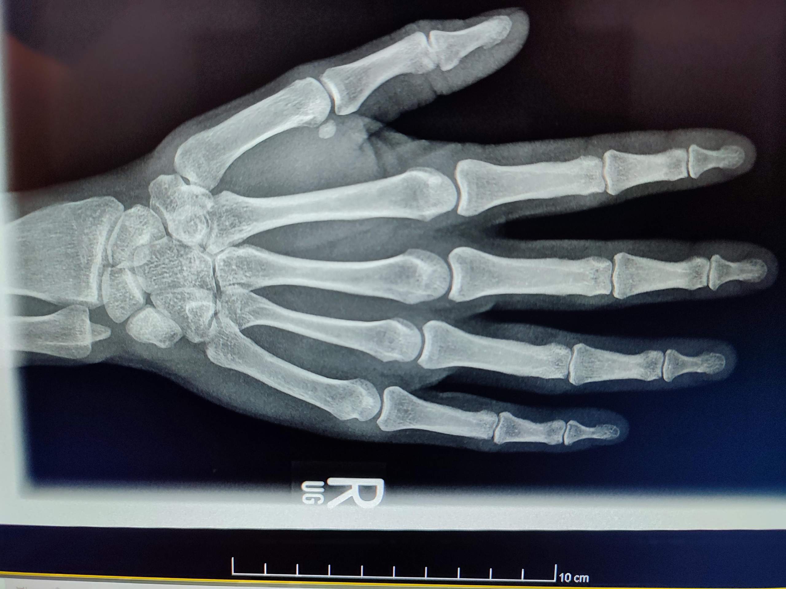 Befundung Röntgenbild der Hand? (Gesundheit und Medizin, Medizin ...