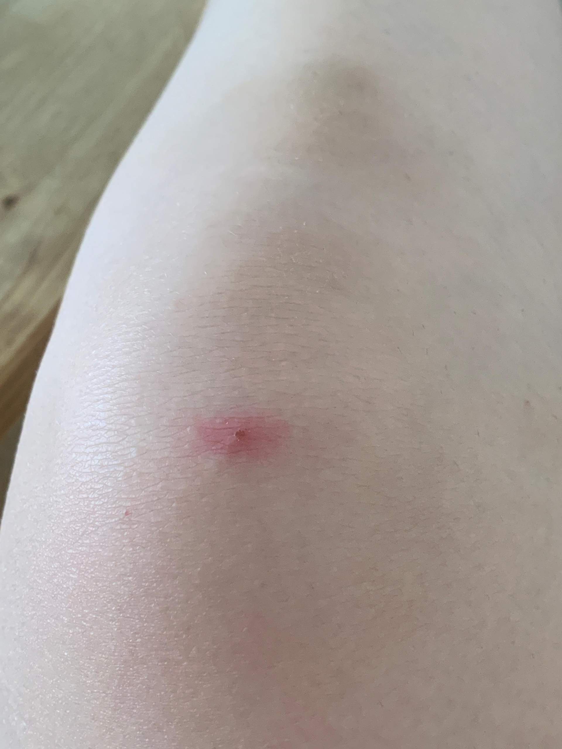 Biss? (Gesundheit und Medizin, Tiere, Insekten)