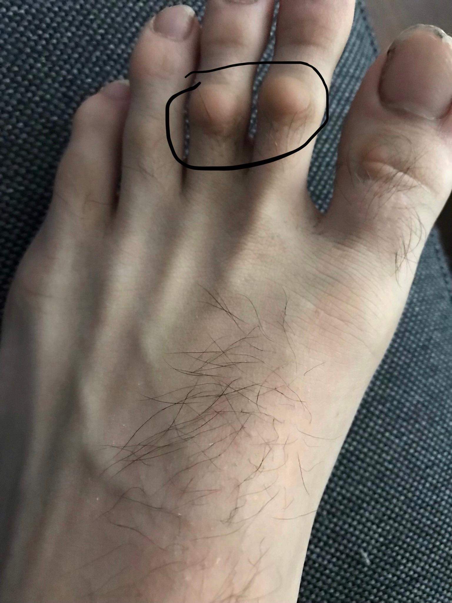 Bläschen am Fuß was ist das? (Füße, blaeschen)