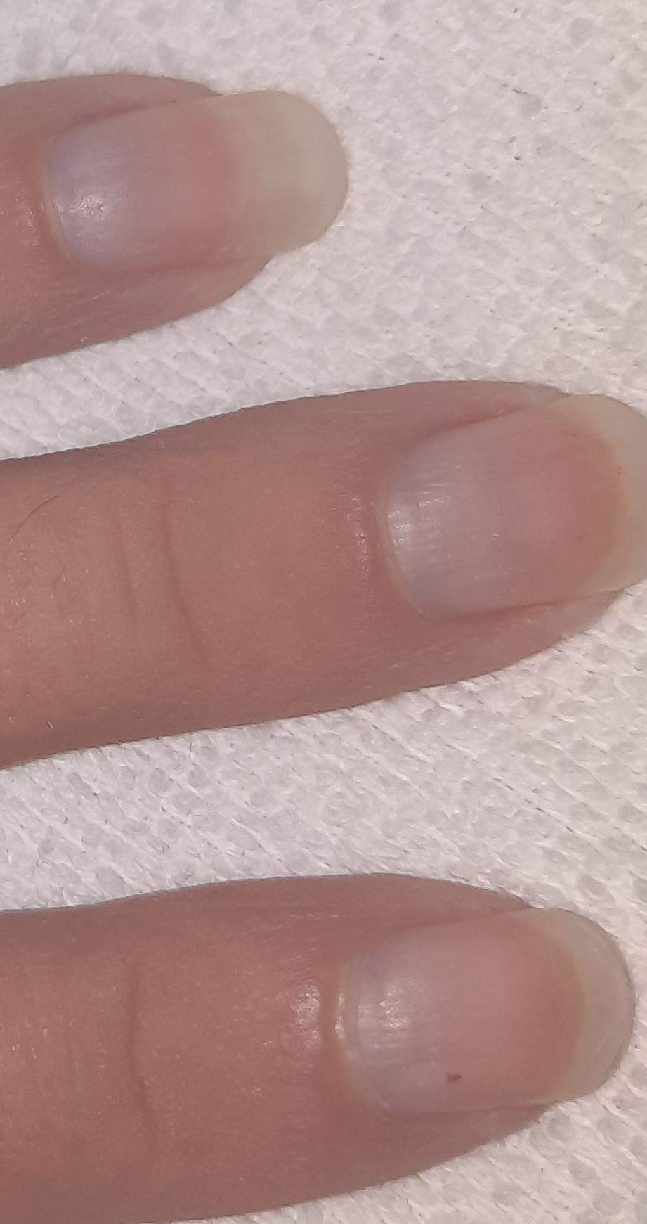 Blaue Fingernägel/Nagelbett? (blau)