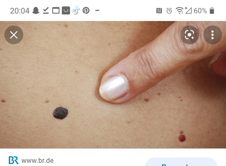 bösartiger muttermal? (Gesundheit und Medizin)