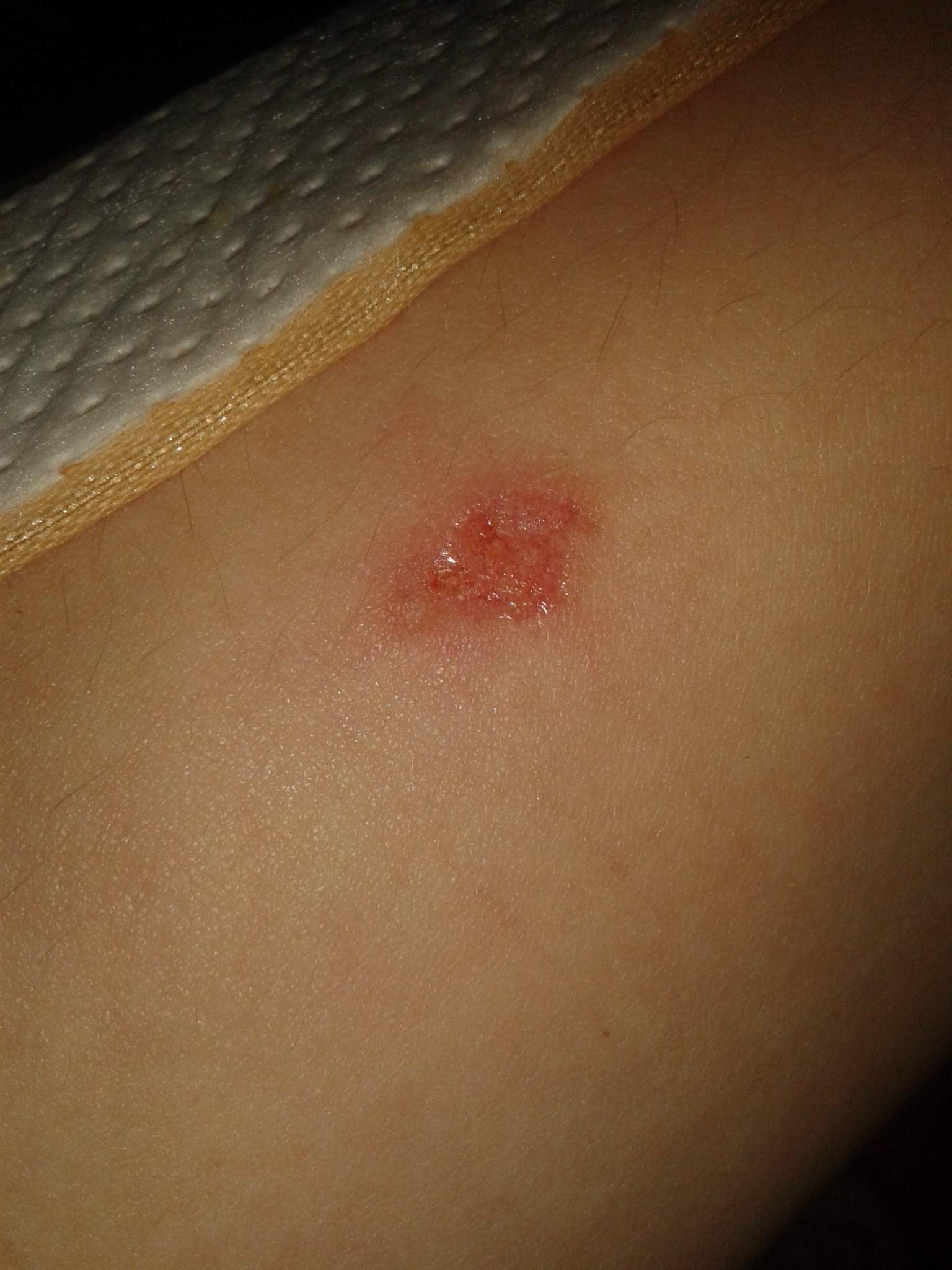 Brandblase abgerissen,wird das eine Narbe? (Narben)