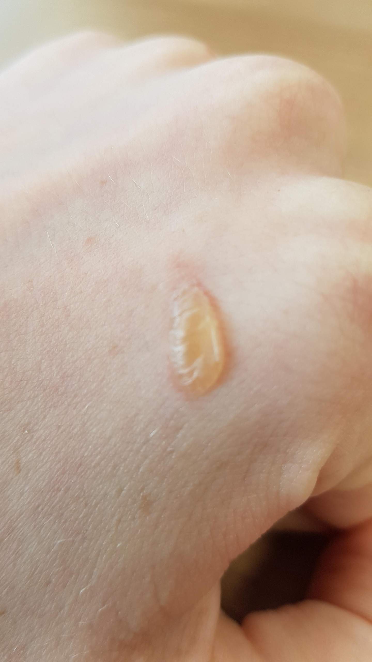 Brandblase behandelnn? (Gesundheit und Medizin, Medizin, Verbrennung)