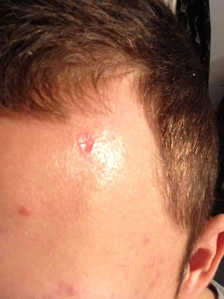 Brandwunde durch eine Zigarette (Zigaretten, Brandverletzung)