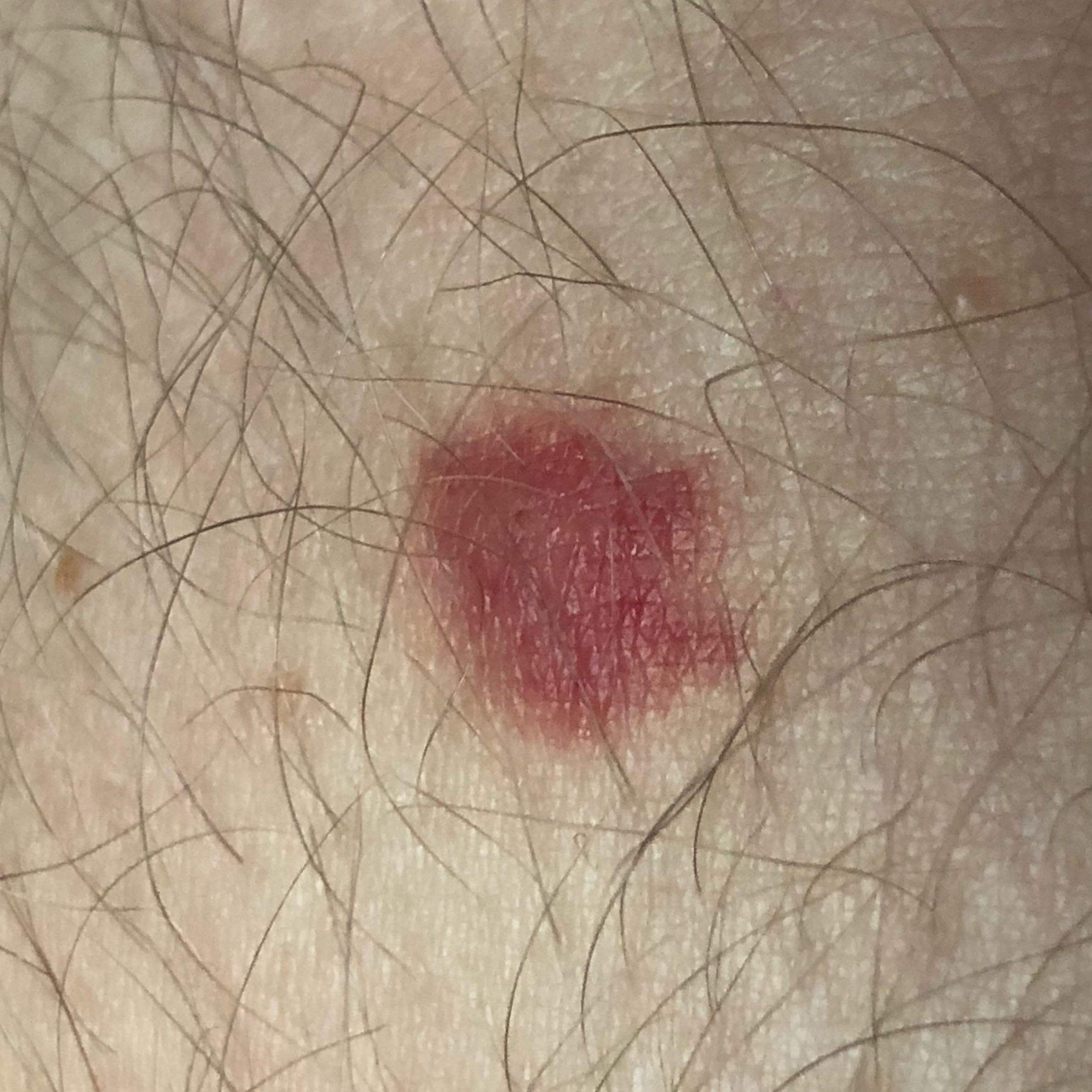 Bremsenstich groß und sehr rot? (Gesundheit und Medizin, Gesundheit ...