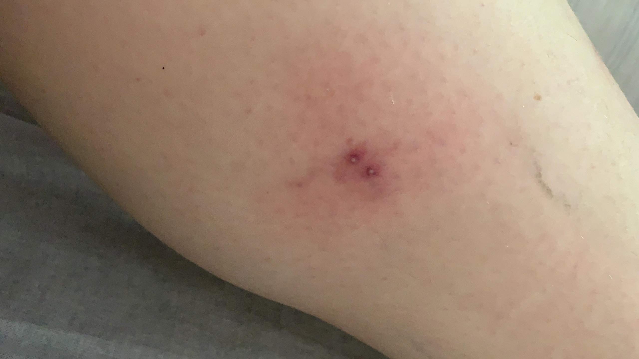 Bremsenstich habt ihr Erfahrungen? (Hausmittel, Insektenstich)