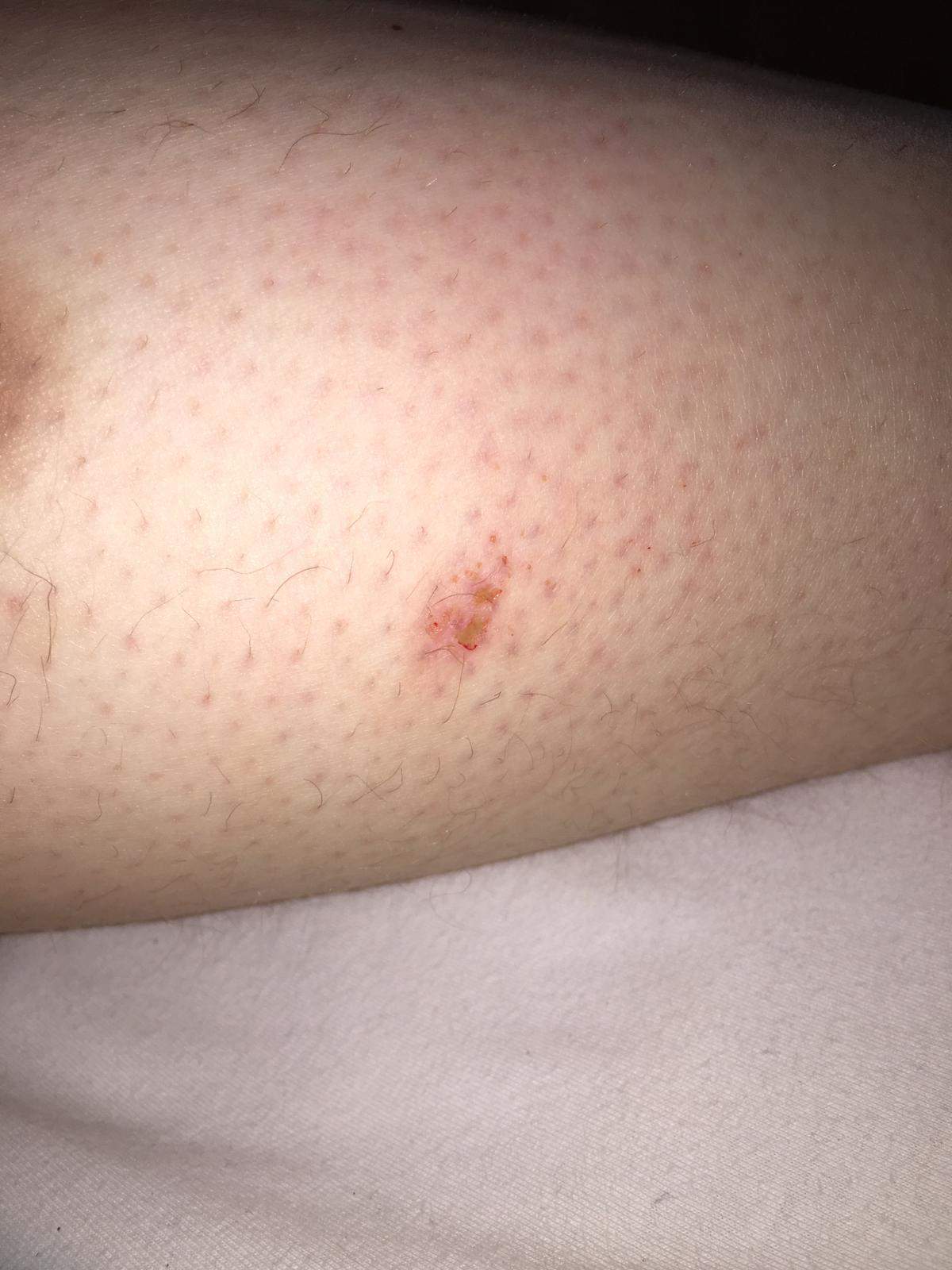 Bremsenstich ist angeschwollen? (Gesundheit und Medizin, Gesundheit, Leben)