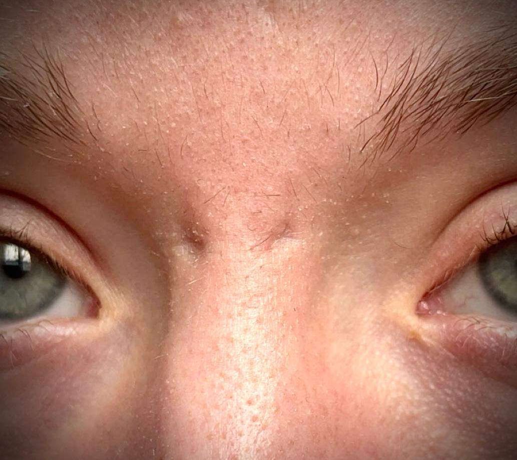 Bridge Piercing Narbe heilen? (Narben, Piercingstudio, Piercingpflege)