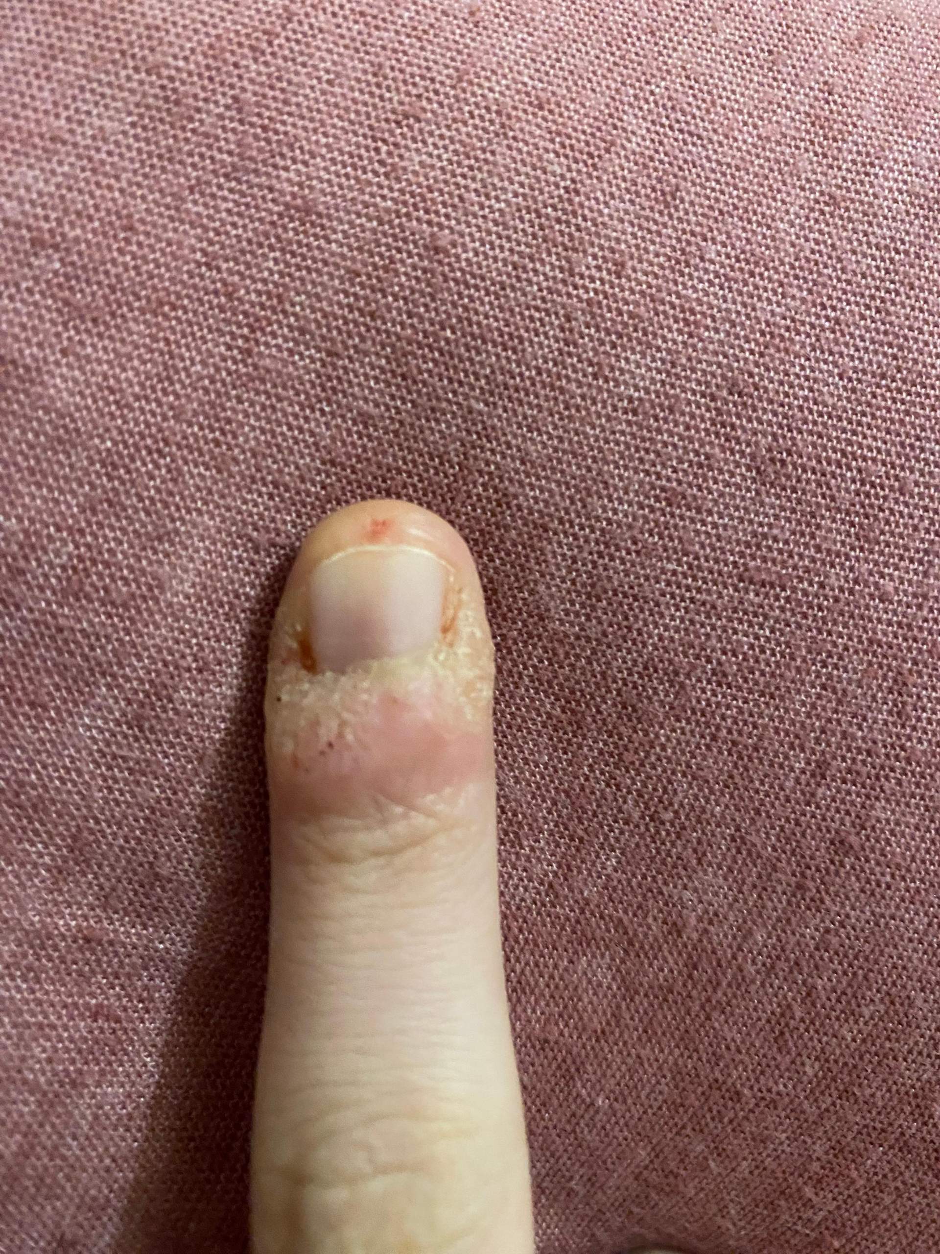Denkt ihr die Warze geht weg? (Hand, Hautarzt, Warzen)