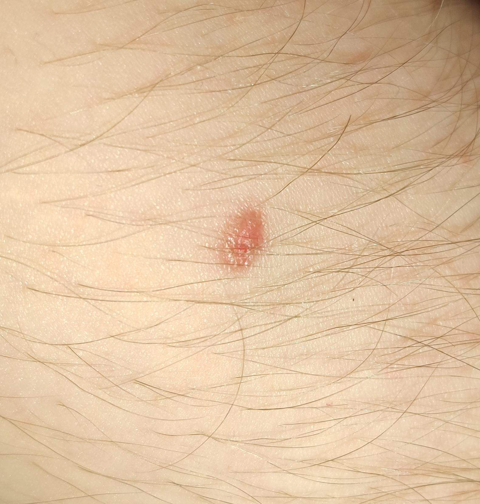 Dermatologe irrt sich eventuell (Weißer Hautkrebs)? (Gesundheit und ...