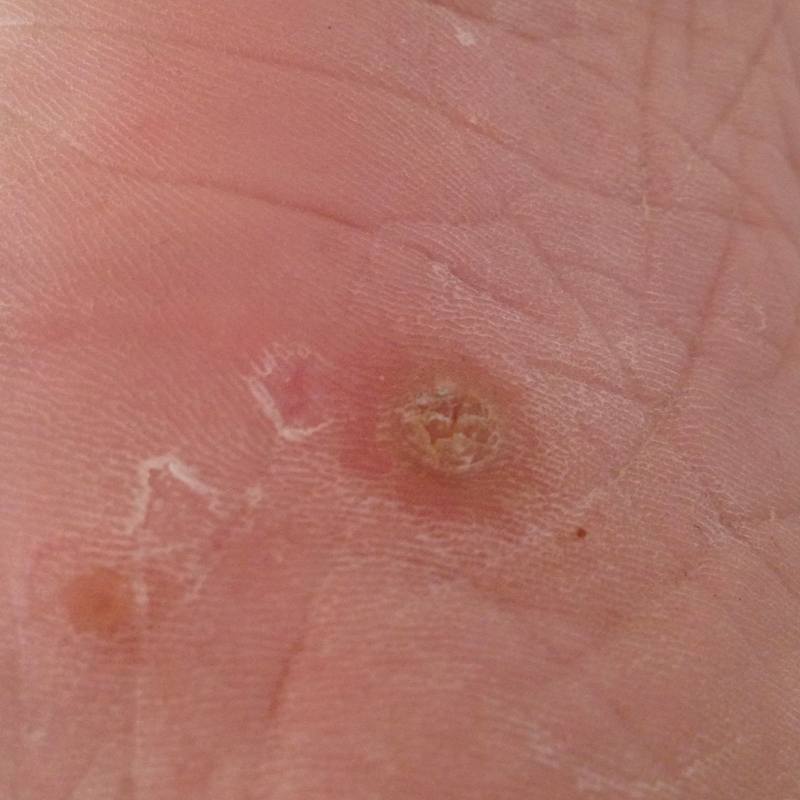 Dornwarze am fuß? HILFE