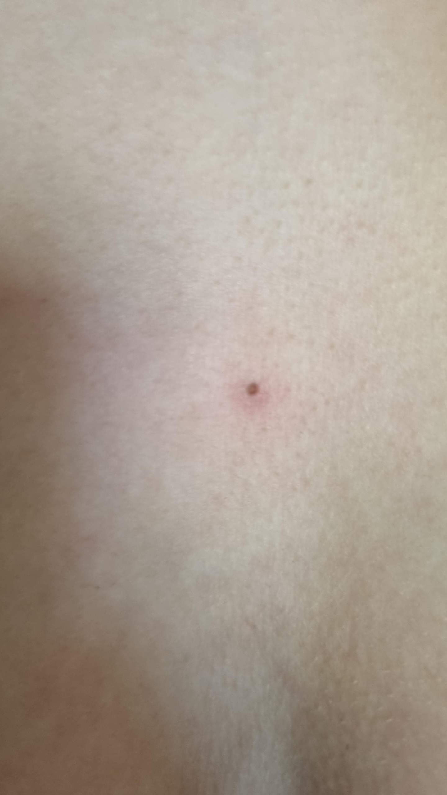 Pickel Zwischen Der Brust Frau - Fragen und Antworten