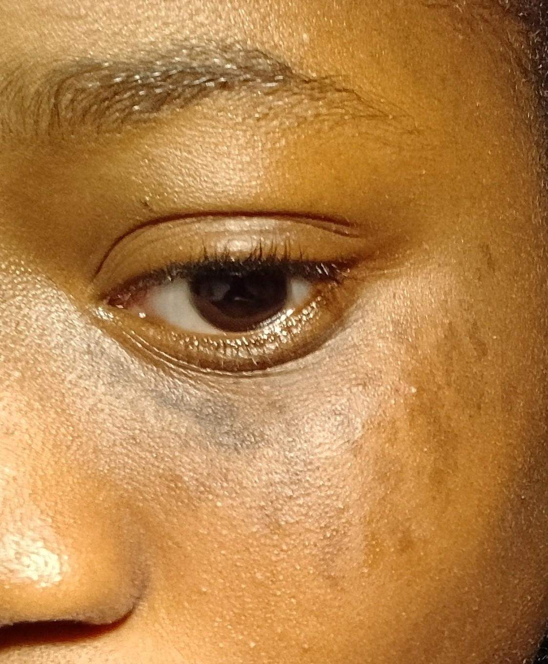 Dunkle wellenartige Flecken unter den augen? (Dermatologie ...