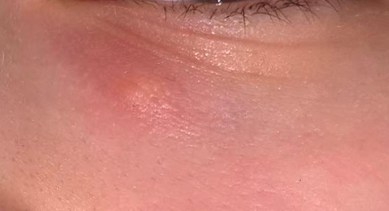 Eiterpickel unter Auge? (Gesundheit und Medizin, Gesundheit, Augen)