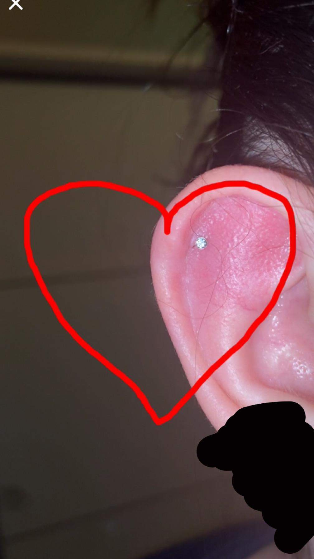 Entzündung am Helix (Piercing)? (Schmerzen, Pflege, Ohr)