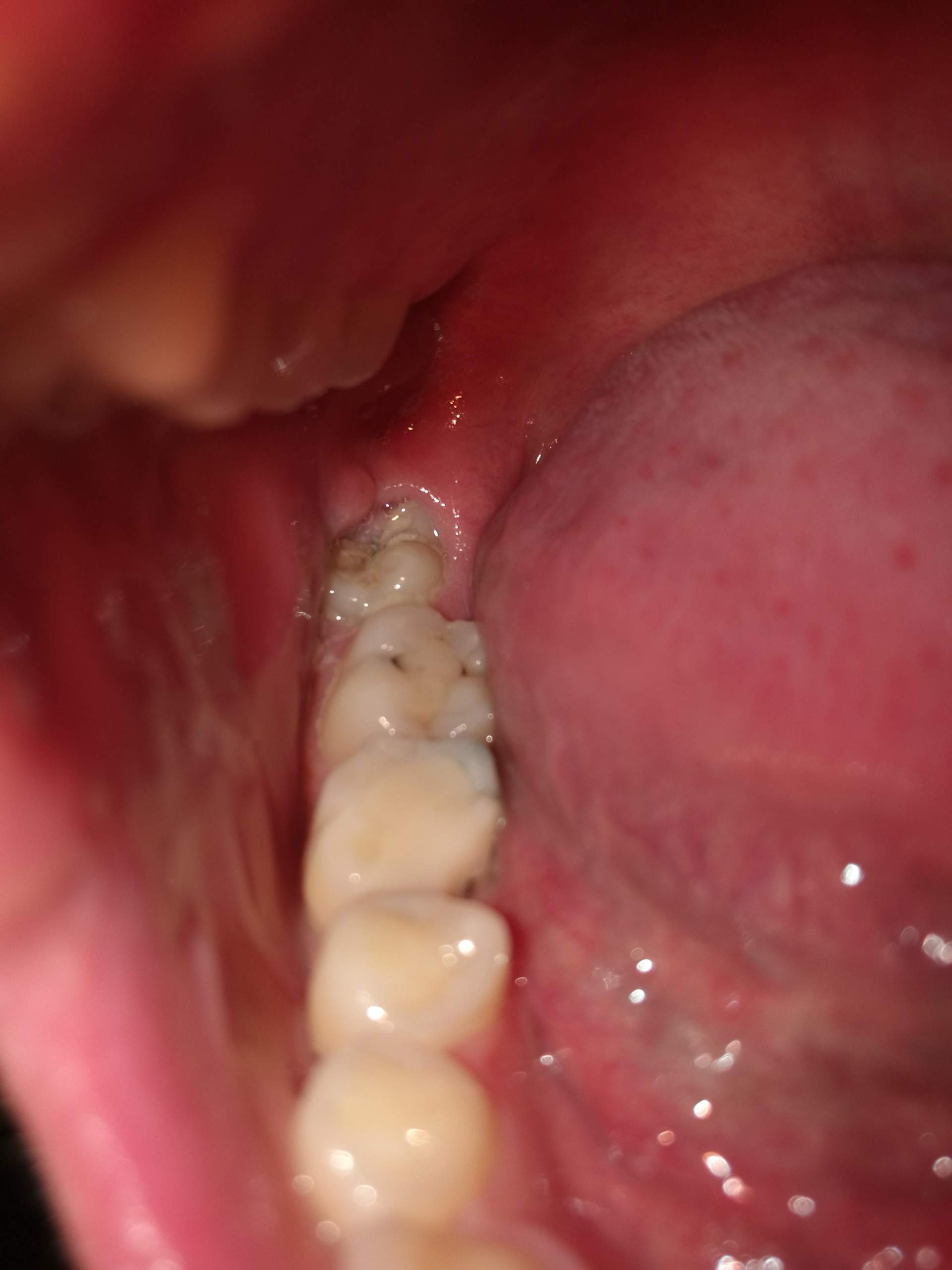 Entzündung an der wange? (Zahnmedizin, entzündet)