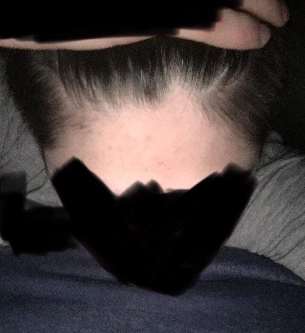 Erblicher Haarausfall mit 15?