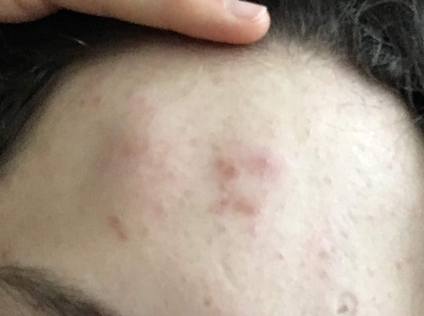 Erhebung auf der Stirn, was ist das? (Gesundheit, Medizin, Arzt)