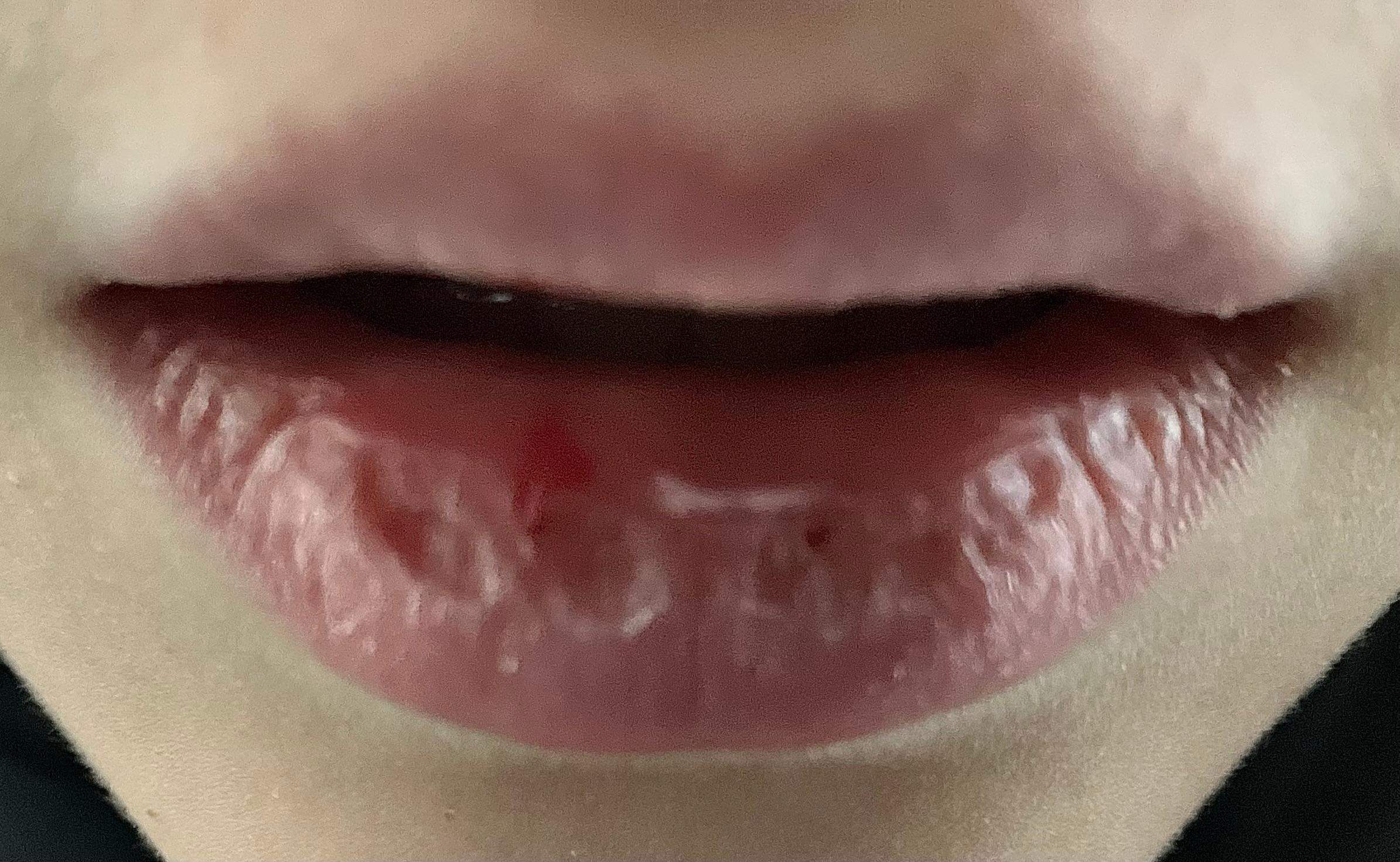 Extrem trockene und kaputte Lippen? (Mädchen, Gesundheit, Frauen)