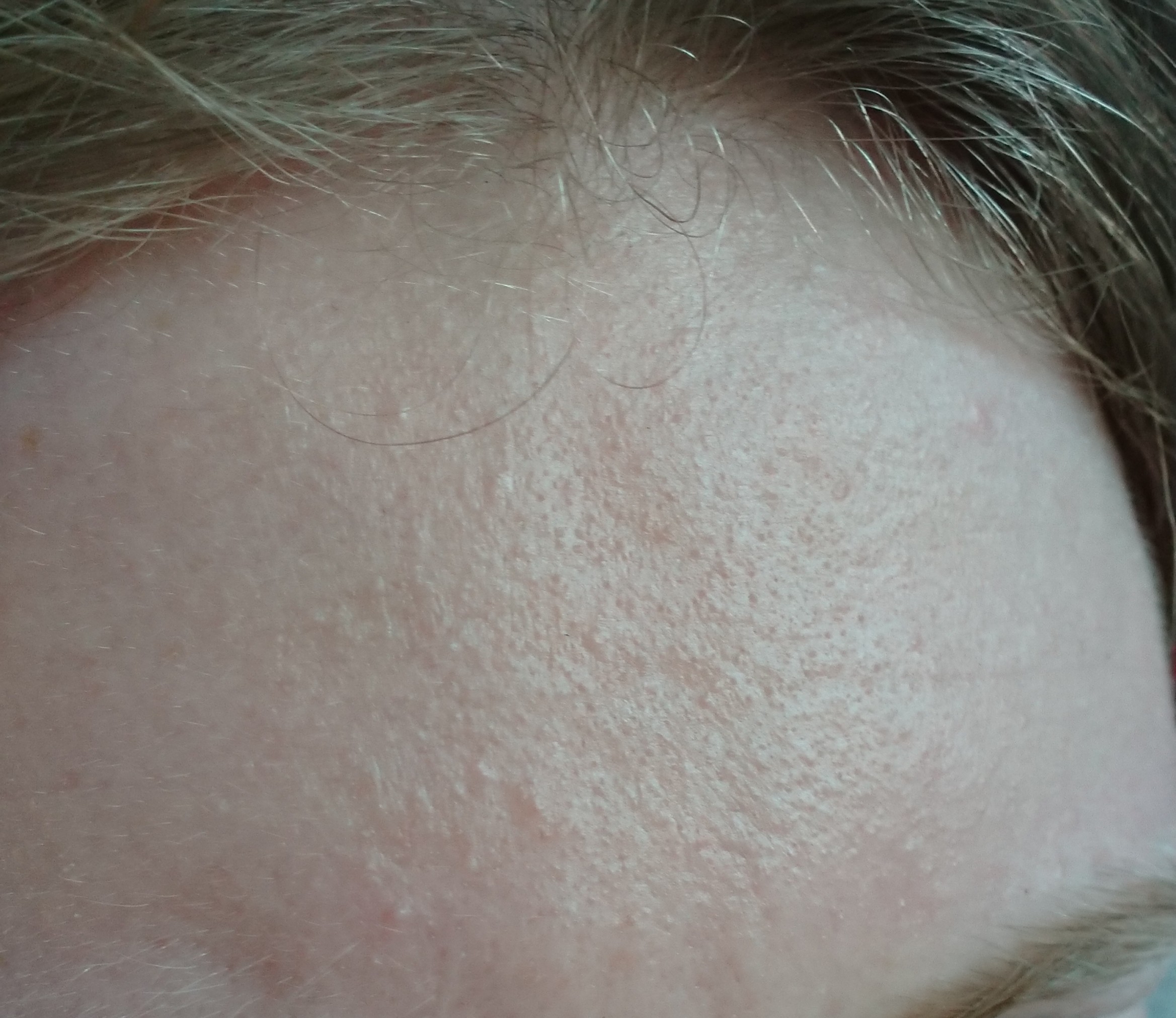 Fiese Mitesser? (Pickel, Hautpflege)