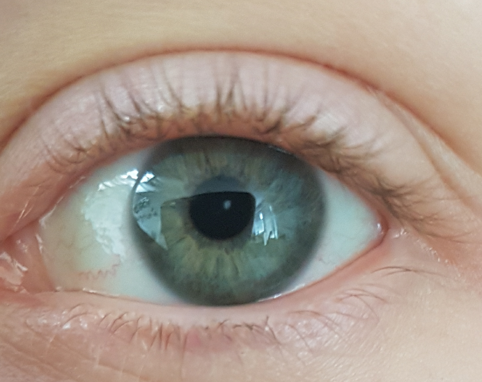 Fleck in Pupille seit Geburt? (Gesundheit und Medizin, Medizin, Augen)