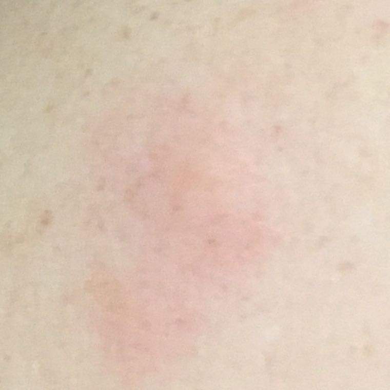 Floh oder Mückenstiche? (Stich, Mücken, Flöhe)