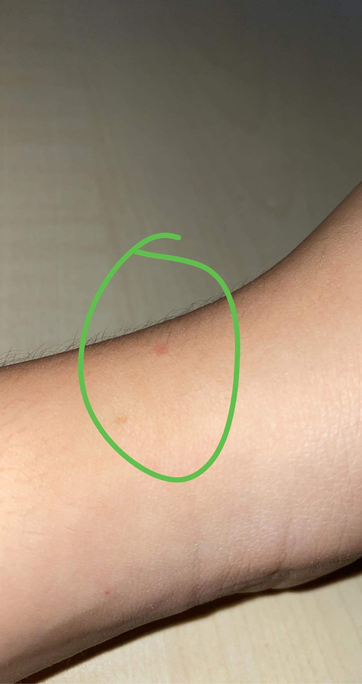 Flohbiss? (Tiere, Flöhe)